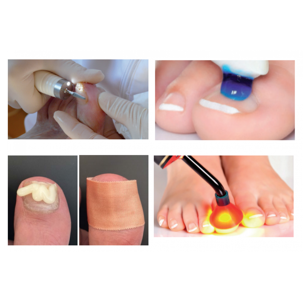 PACT Med Photodynamic Nail Fungus Therapy Kit - PACTmed Nail Fungus ...